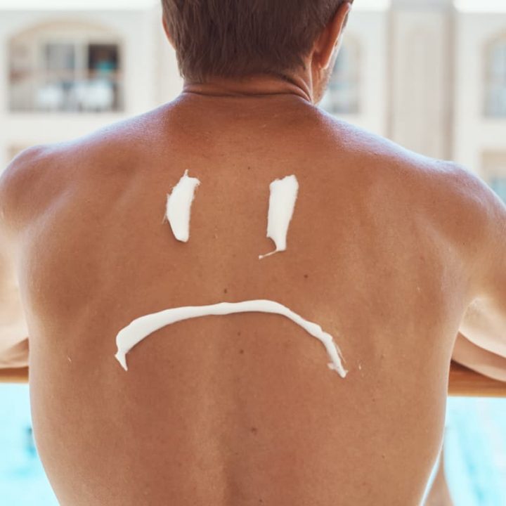 How To Sleep With Sunburn: 5 Proven Home Remedies That Work