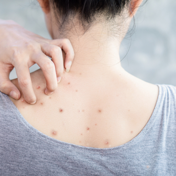 ᐅ How & Where Can I Get Treatment For My Bacne? | E-Surgery
